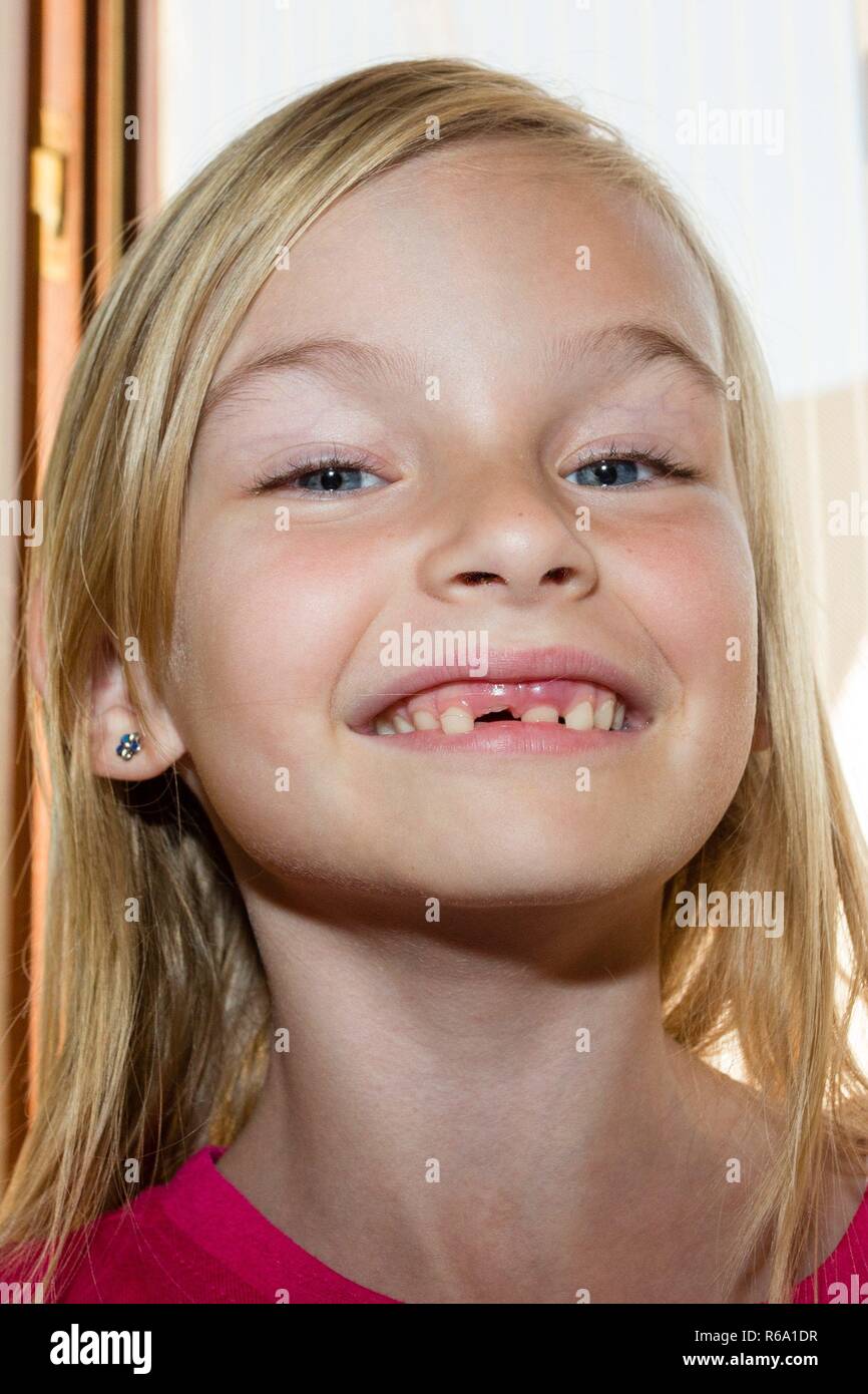 A Seven Year Old Girl With A Missing Upper Incisor Smiling Leutenbach a-seven-year-old-girl-with-a-missing-upper-incisor-smiling-leutenbach