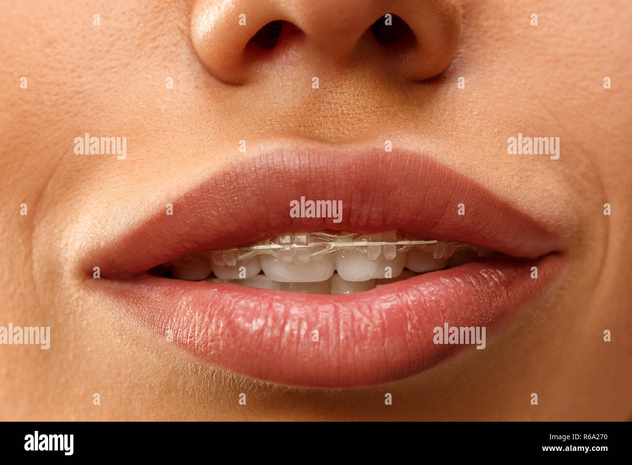 Beautiful young woman with teeth braces close up Stock Photo - Alamy