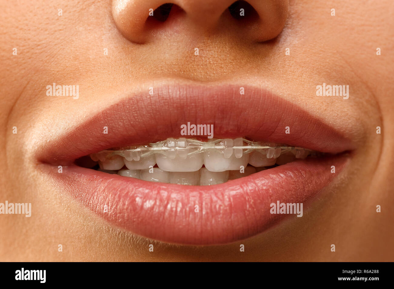 Beautiful young woman with teeth braces close up Stock Photo - Alamy