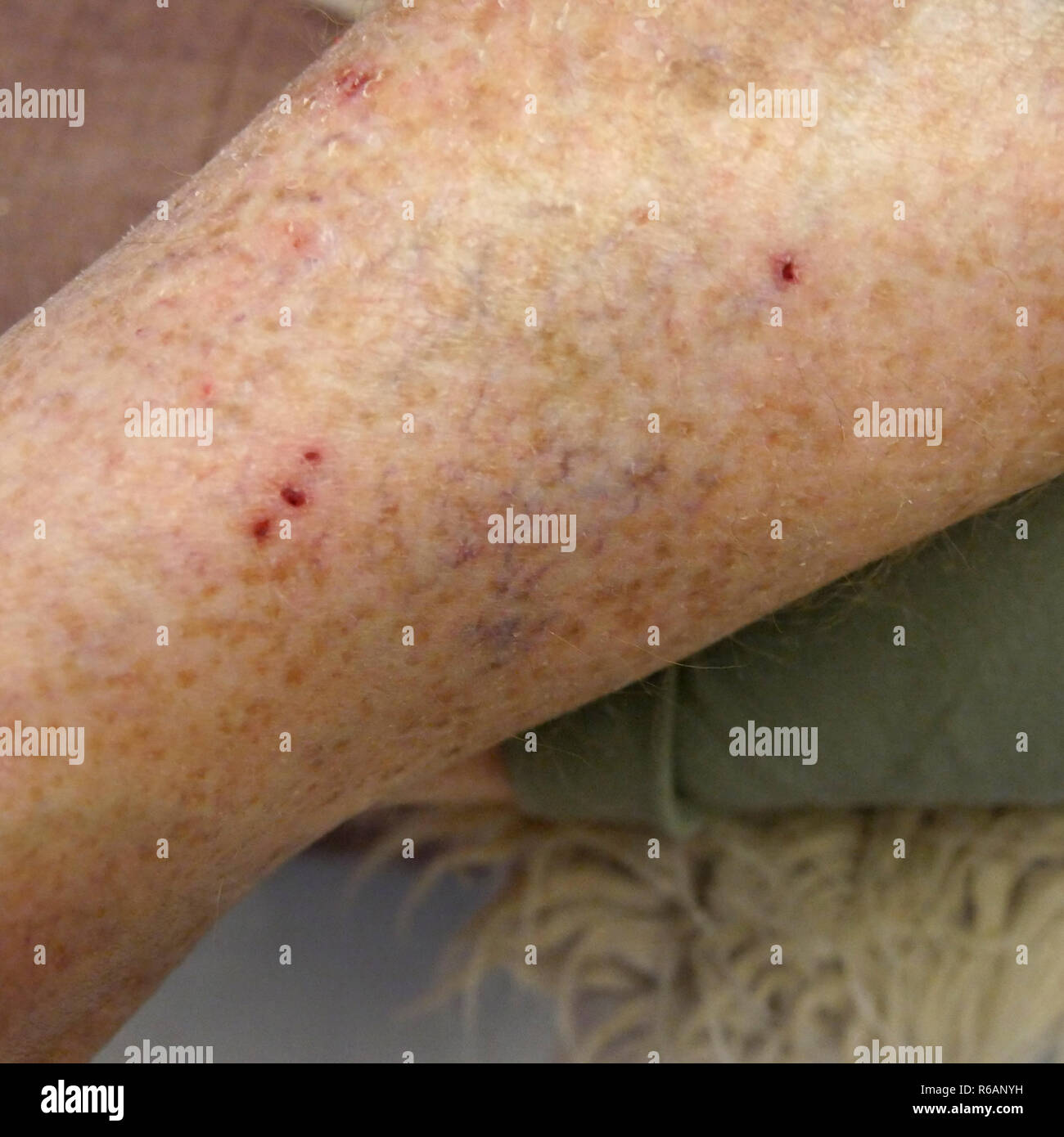 Skin desease hi-res stock photography and images - Alamy Skin desease hi-res stock photography and images - Alamy