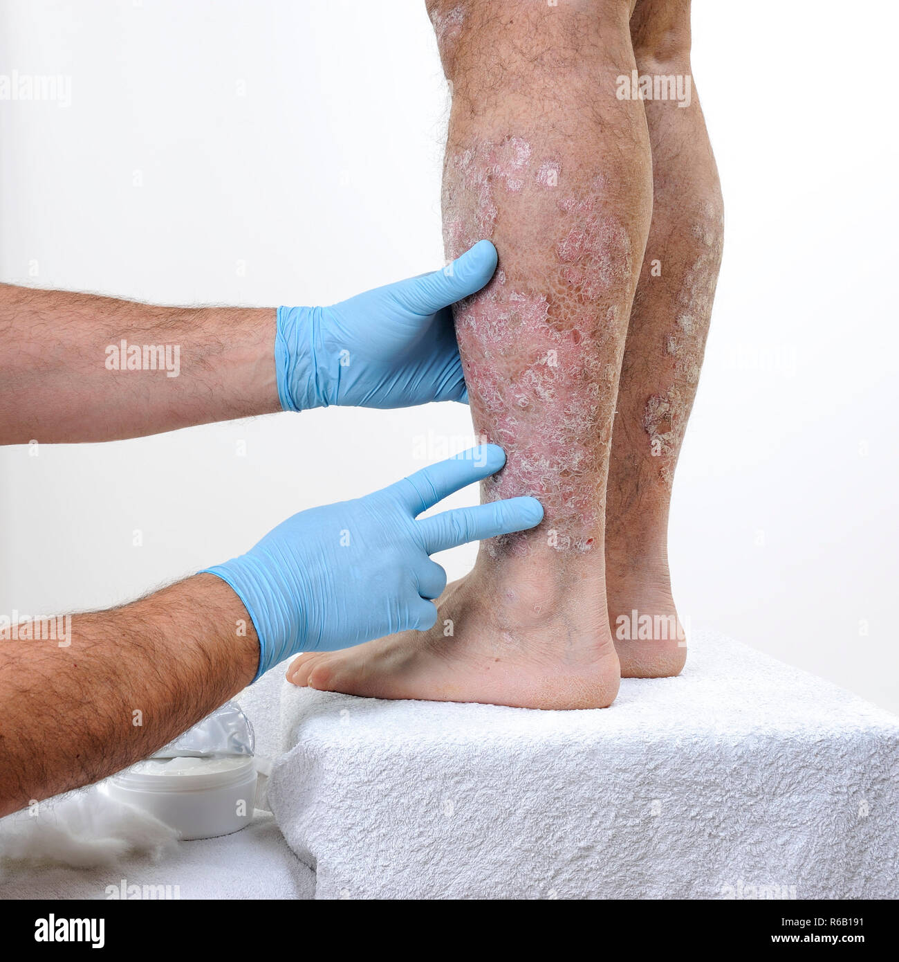 Psoriasis Foot High Resolution Stock Photography and Images - Alamy