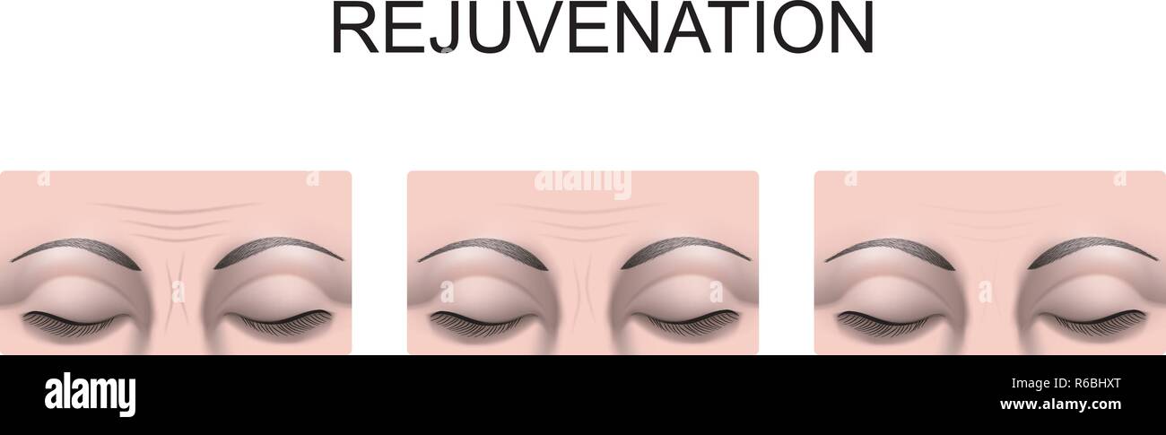 illustration of forehead wrinkles. rejuvenation. plastic surgery Stock ...