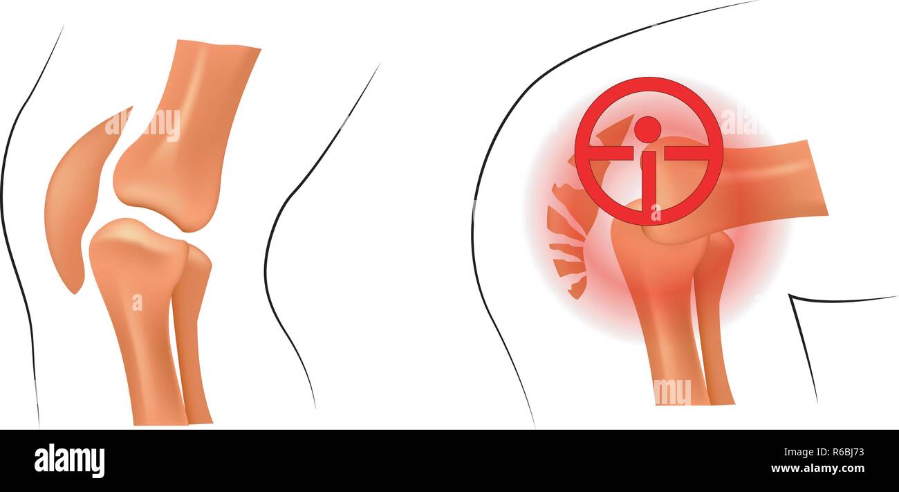 Lattimore Dislocated Knee