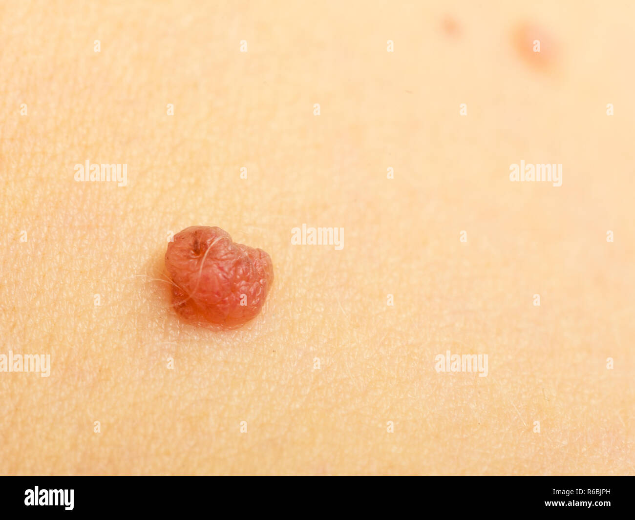 Epidermal nevus hi-res stock photography and images - Alamy