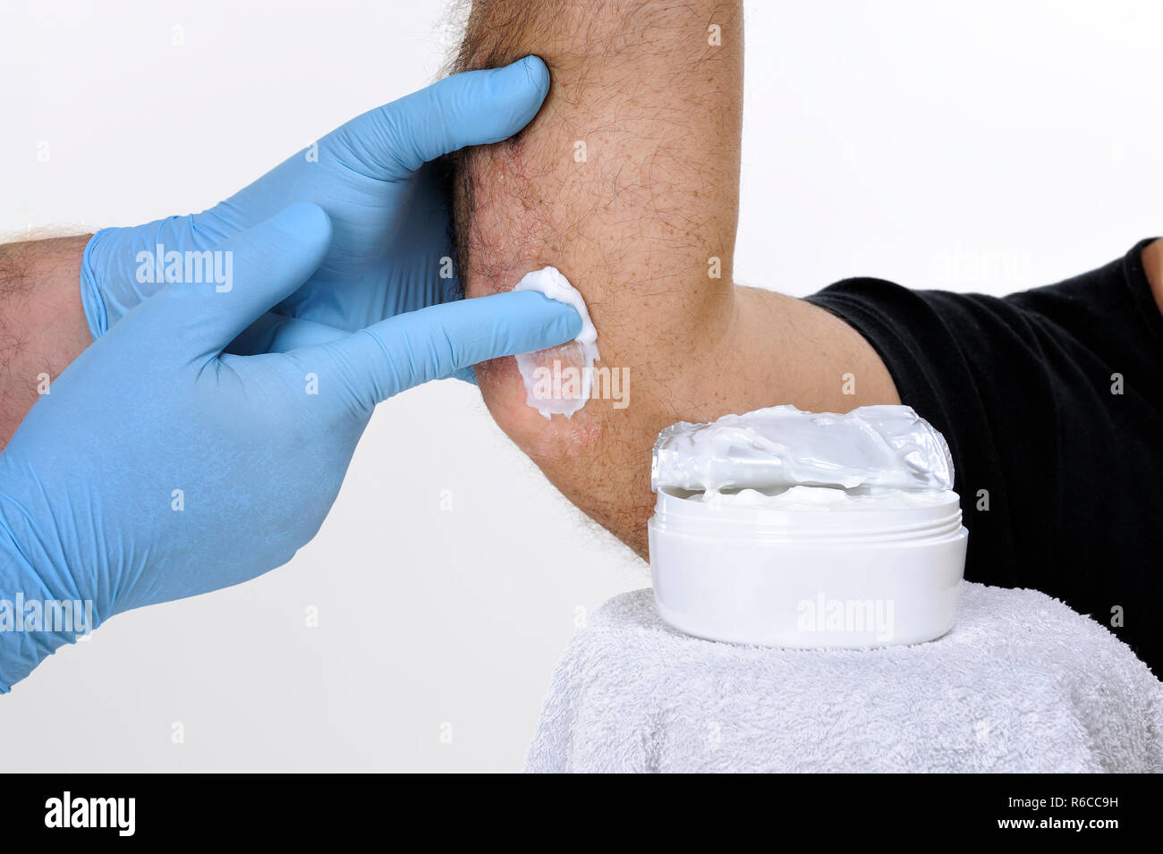 Psoriasis plaques hi-res stock photography and images - Alamy