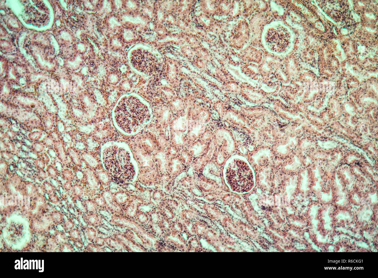 tuberculosis kidney diseased tissue 100x Stock Photo - Alamy