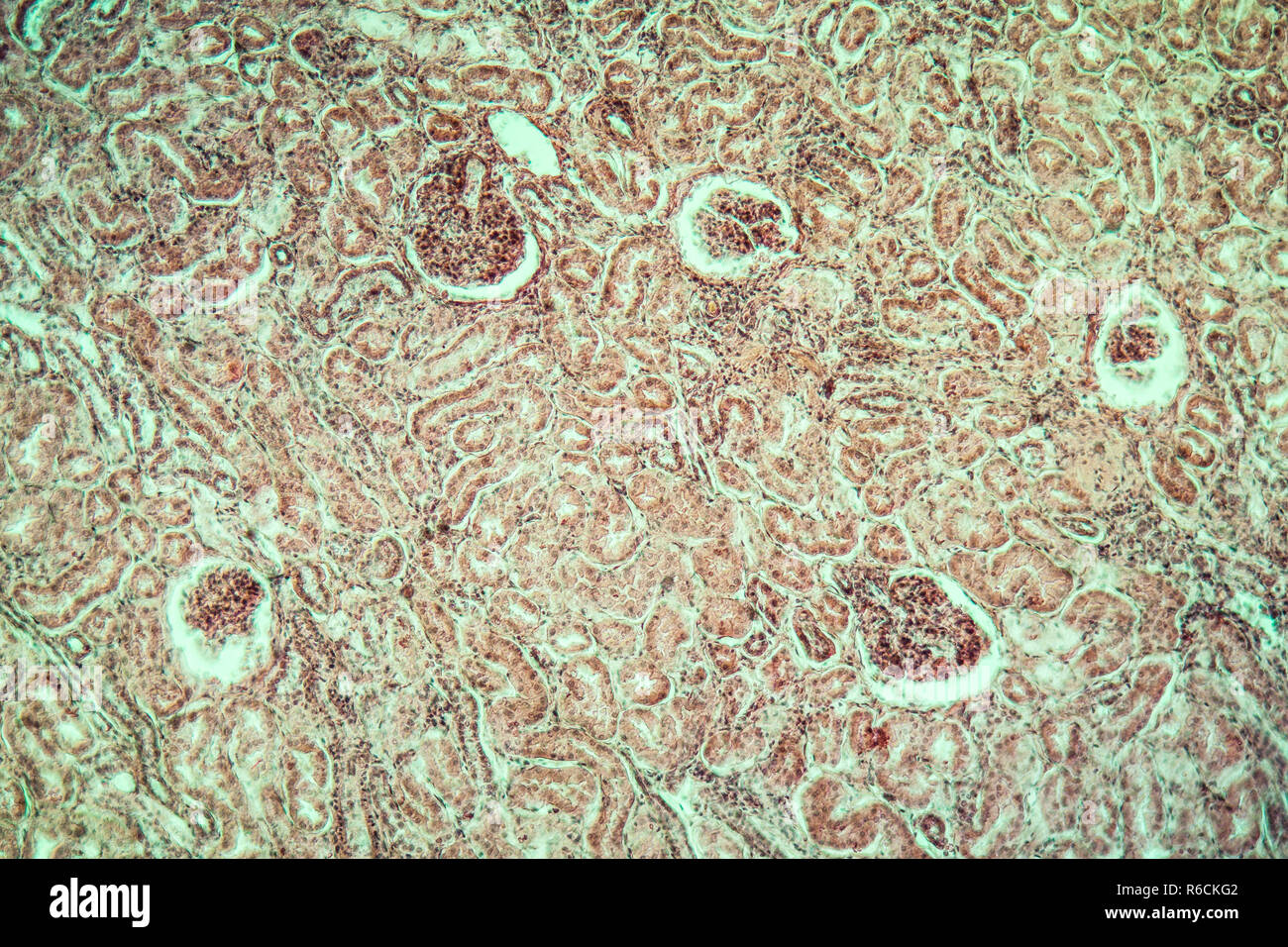 tuberculosis kidney diseased tissue 100x Stock Photo - Alamy