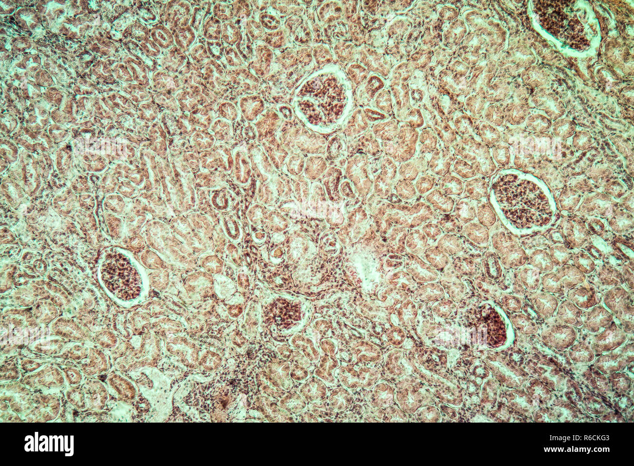 tuberculosis kidney diseased tissue 100x Stock Photo - Alamy