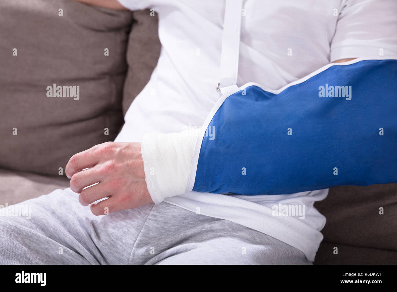 Fractured Man's Hand Stock Photo - Alamy