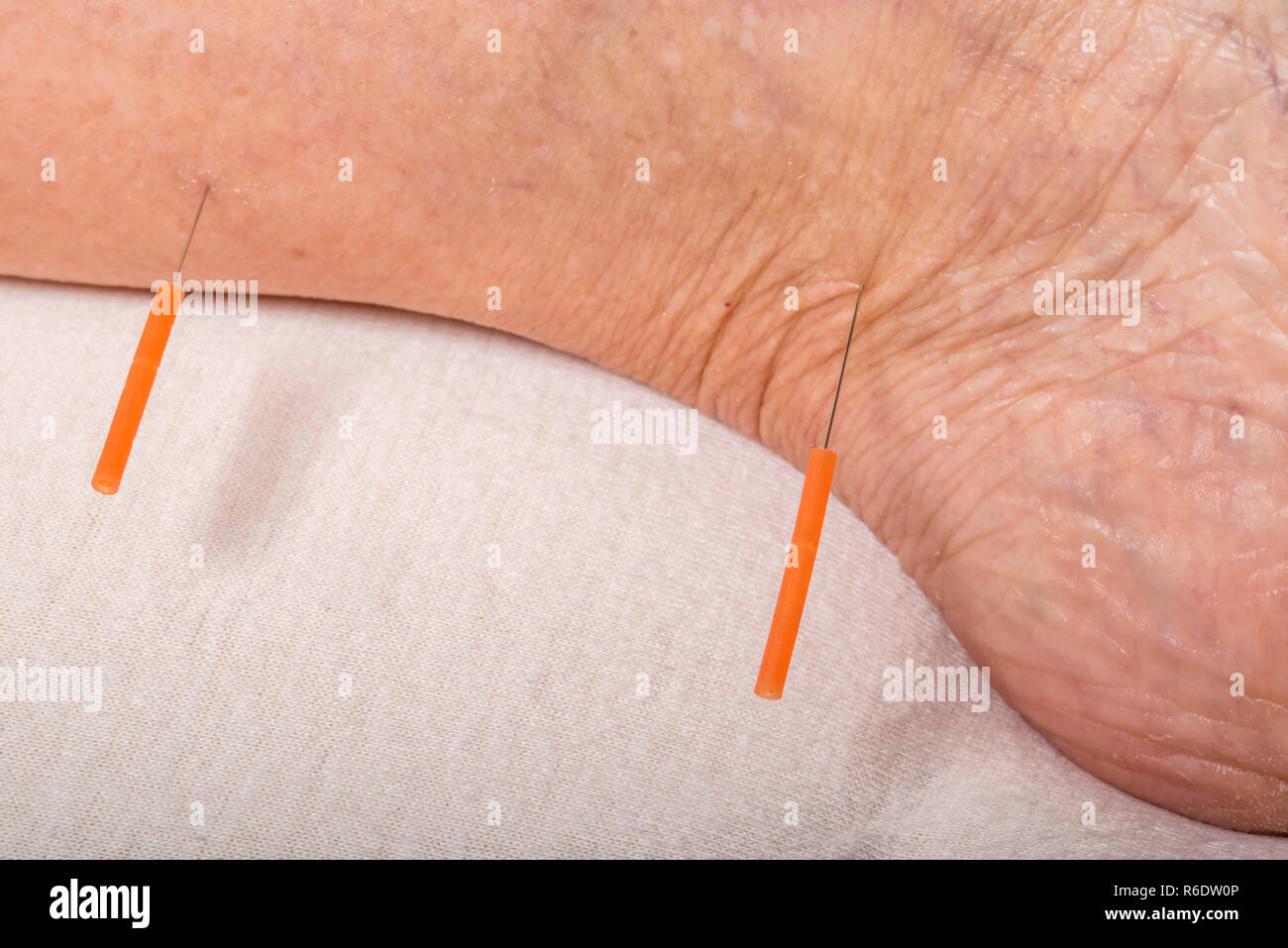 Acupuncture Treatment On Leg Stock Photo - Alamy
