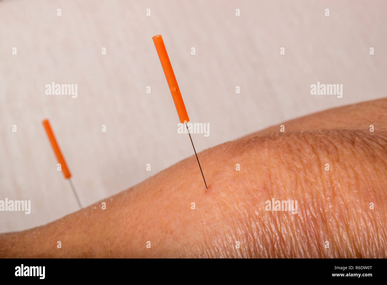 Acupuncture Treatment On Leg Stock Photo - Alamy