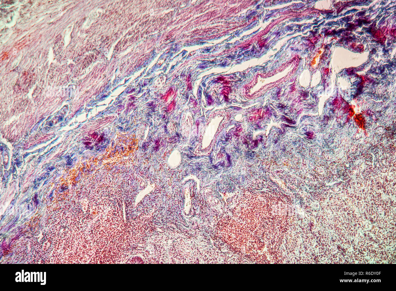 appendicitis diseased tissue 100x Stock Photo - Alamy