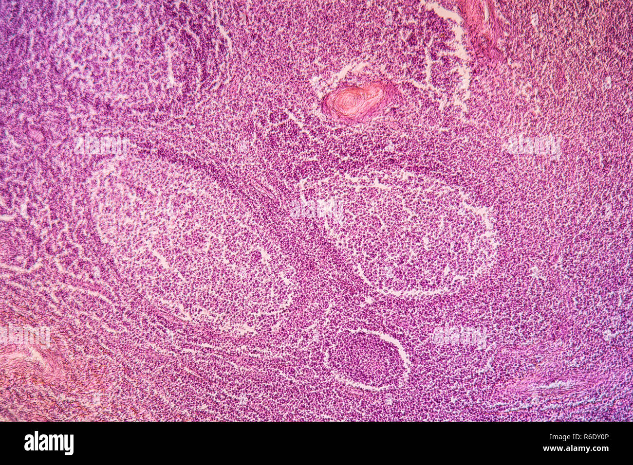 tonsillitis diseased tissue 100x Stock Photo - Alamy