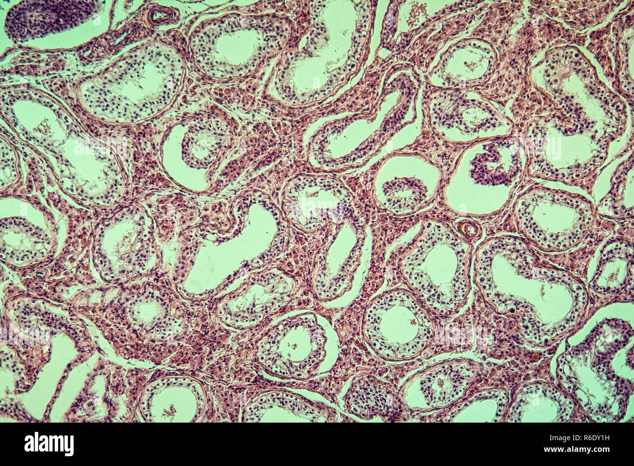 inguinal testis diseased tissue 100x Stock Photo - Alamy