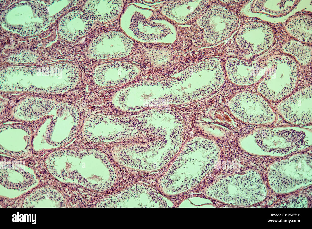 inguinal testis diseased tissue 100x Stock Photo - Alamy