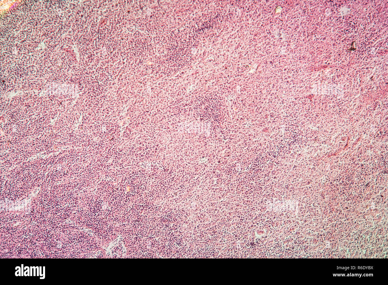 lymphoid tissue myelin sarcoma diseased tissue 100x Stock Photo - Alamy