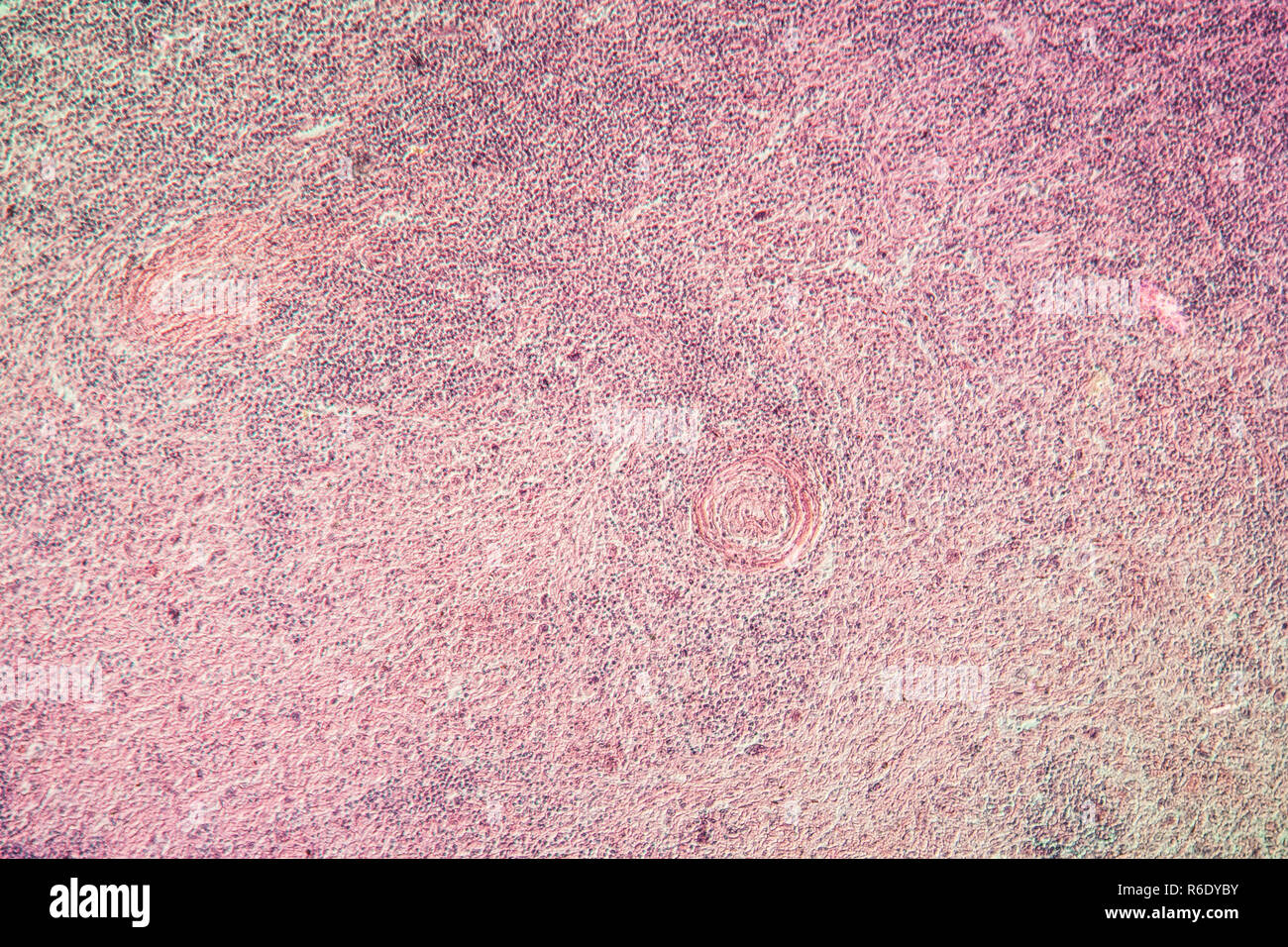 lymphoid tissue myelin sarcoma diseased tissue 100x Stock Photo - Alamy