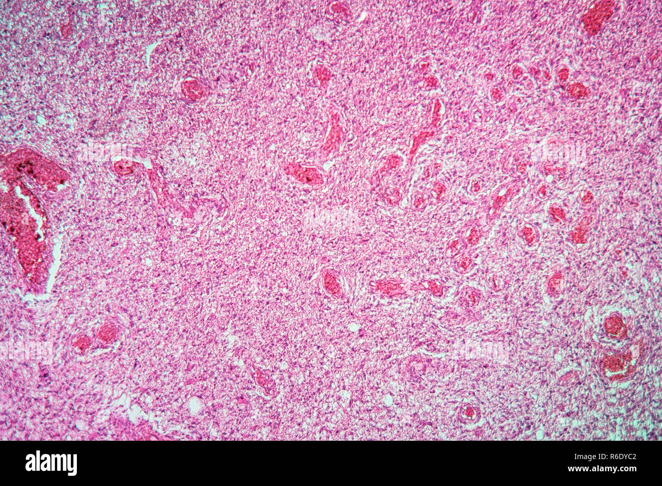 glioma tumor of the brain diseased tissue 100x Stock Photo - Alamy
