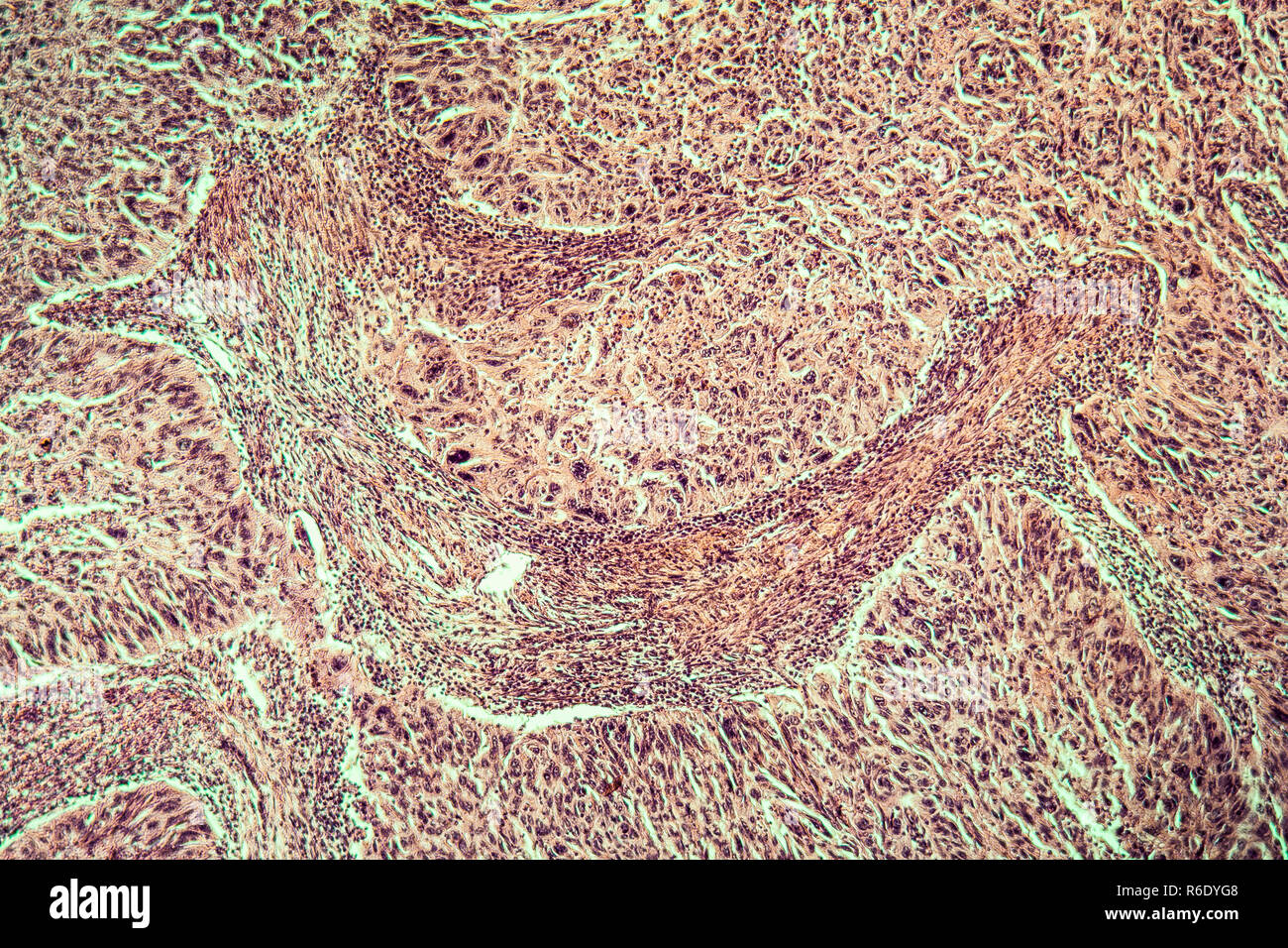 cervical carcinoma diseased tissue 100x Stock Photo - Alamy