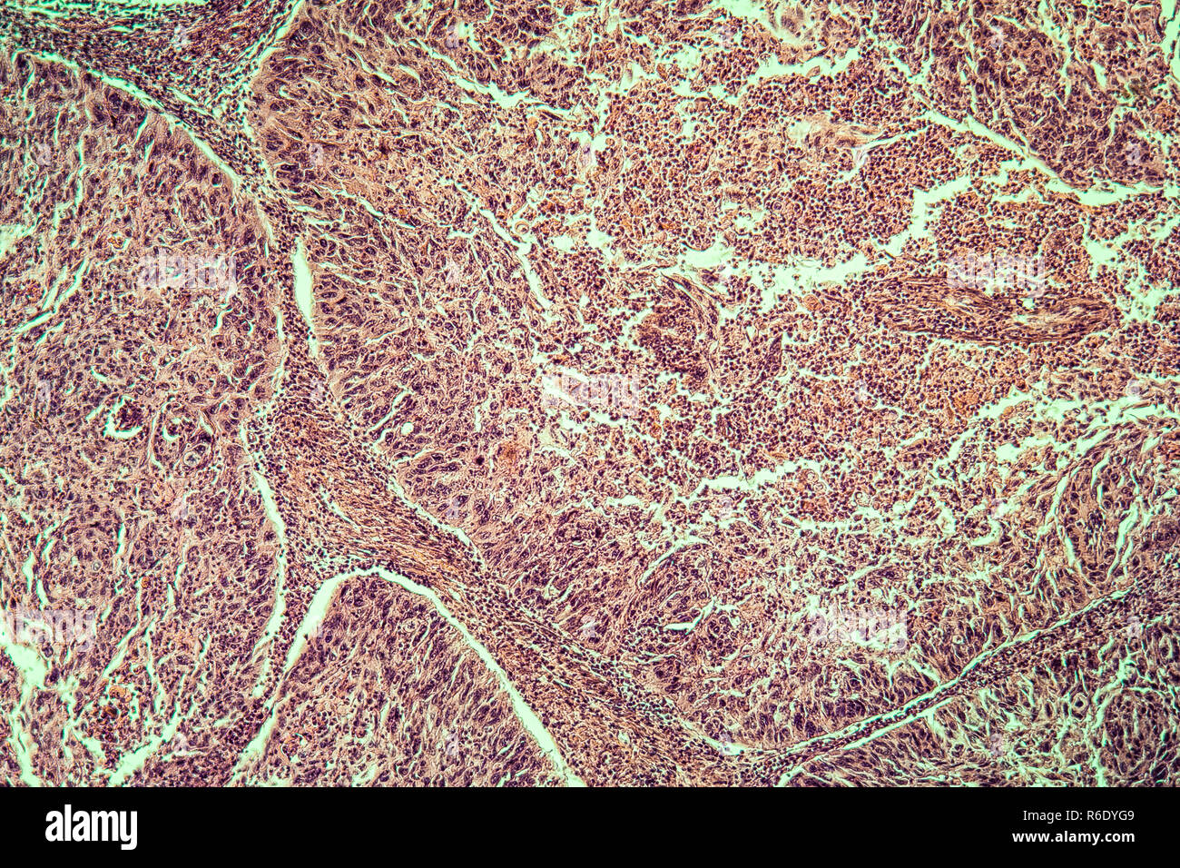 cervical carcinoma diseased tissue 100x Stock Photo - Alamy