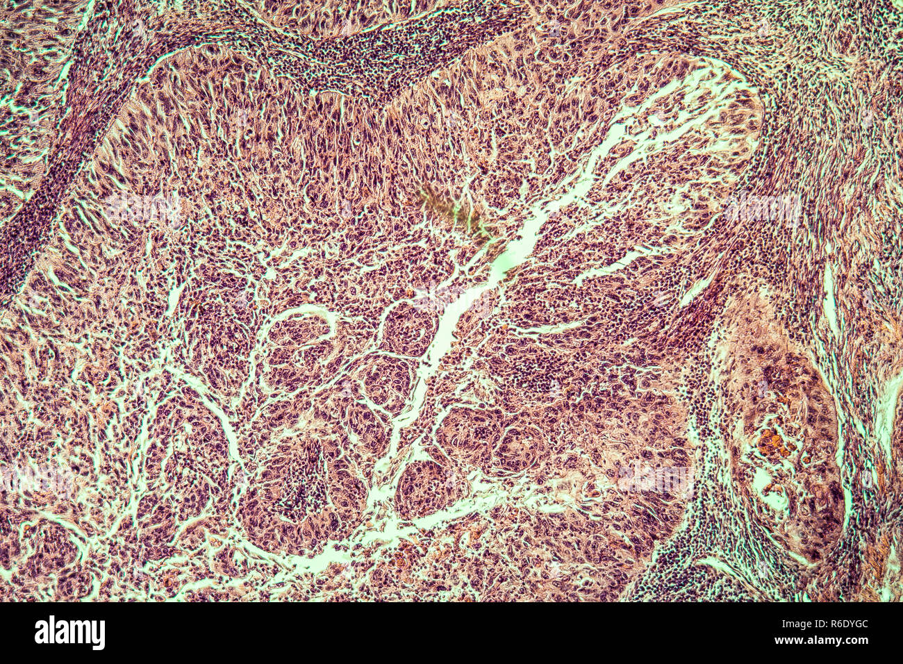 cervical carcinoma diseased tissue 100x Stock Photo - Alamy