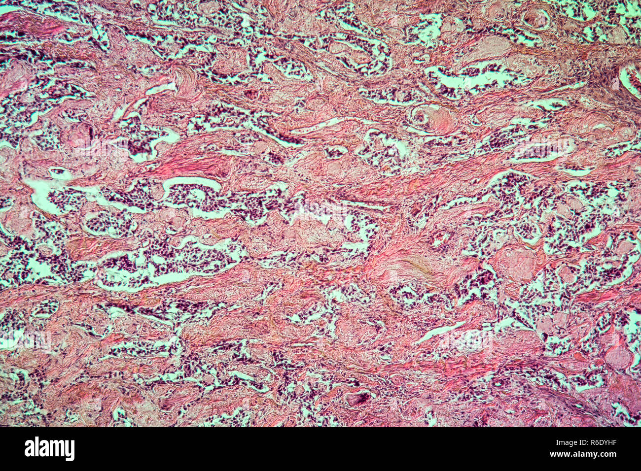 fibromyoma,good tumor of the uterus diseased tissue 100x Stock Photo ...