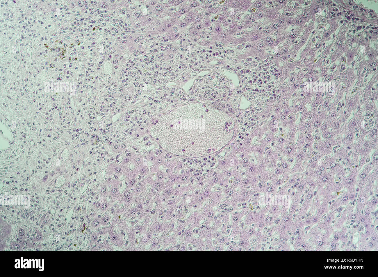 liver mouse,schistosomiasis diseased tissue 100x Stock Photo - Alamy