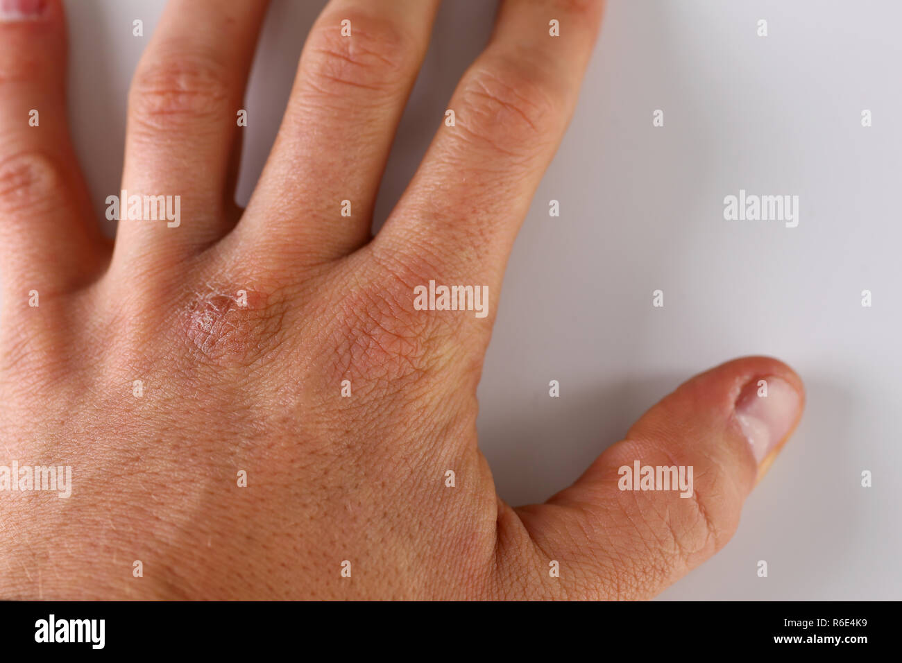 Damaged male arm with corrupted dry skin Stock Photo - Alamy