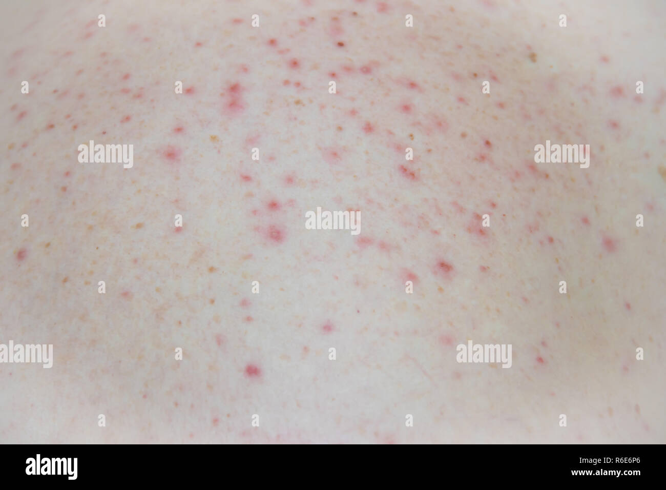 Problem skin. Acne on the skin. Texture of oily problem skin with acne ...