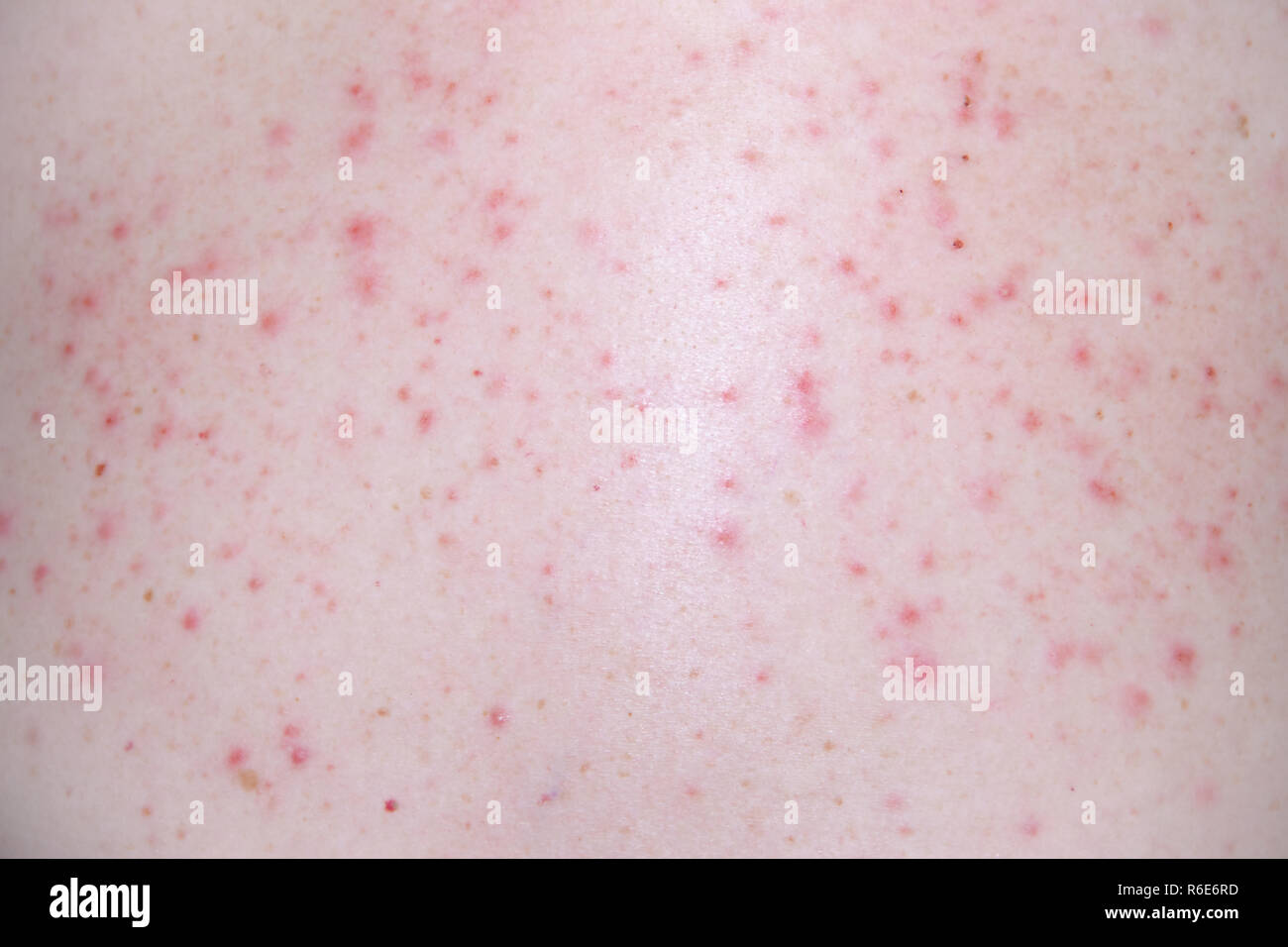 Problem skin. Acne on the skin. Texture of oily problem skin with acne ...