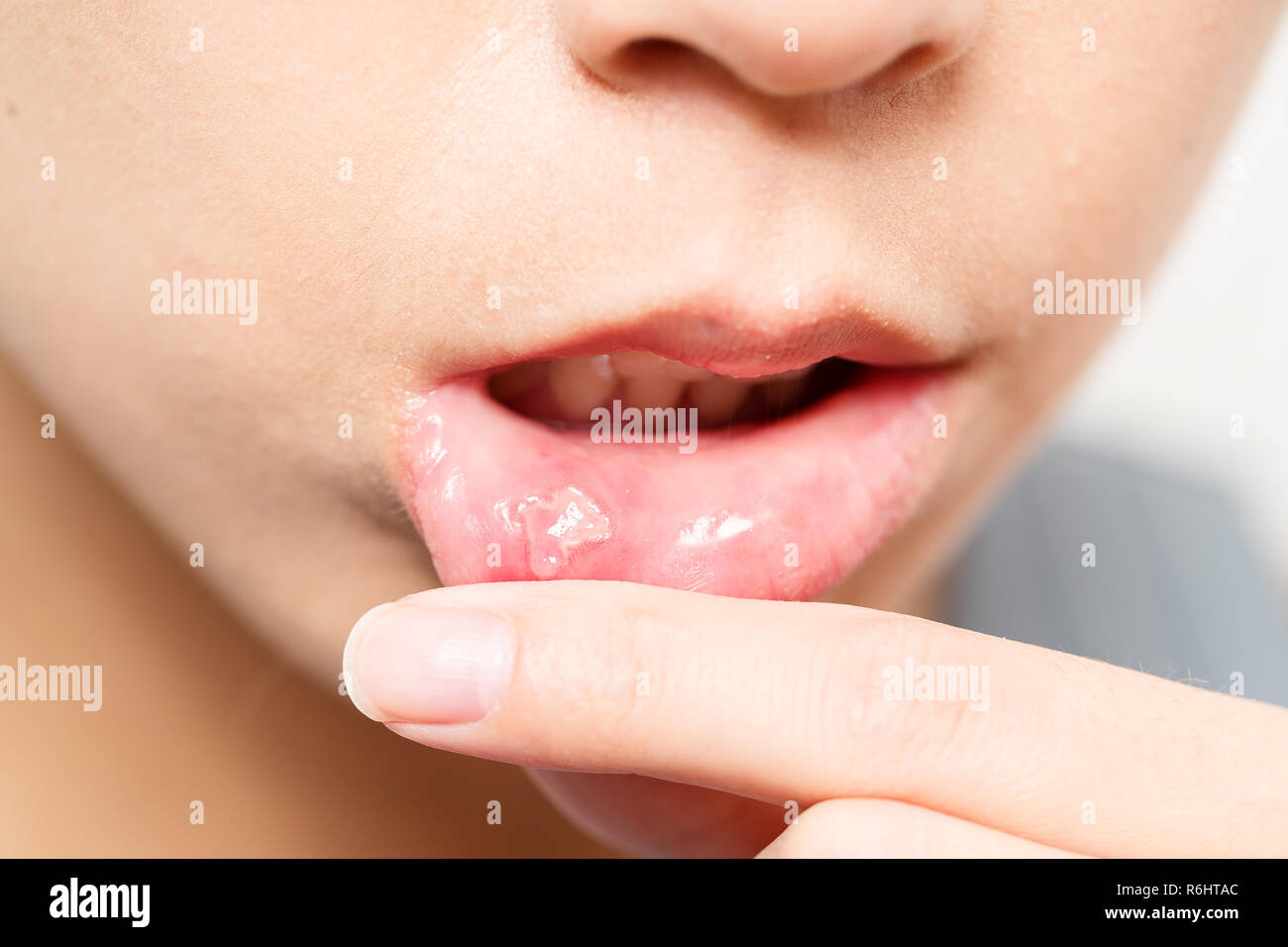 Oral thrush woman hi-res stock photography and images - Alamy