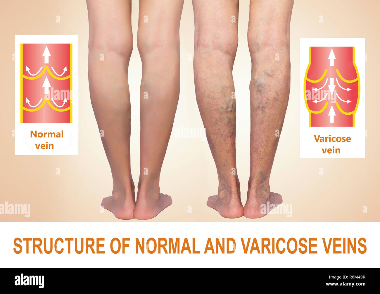 Varicose veins on a female senior leg Stock Photo - Alamy