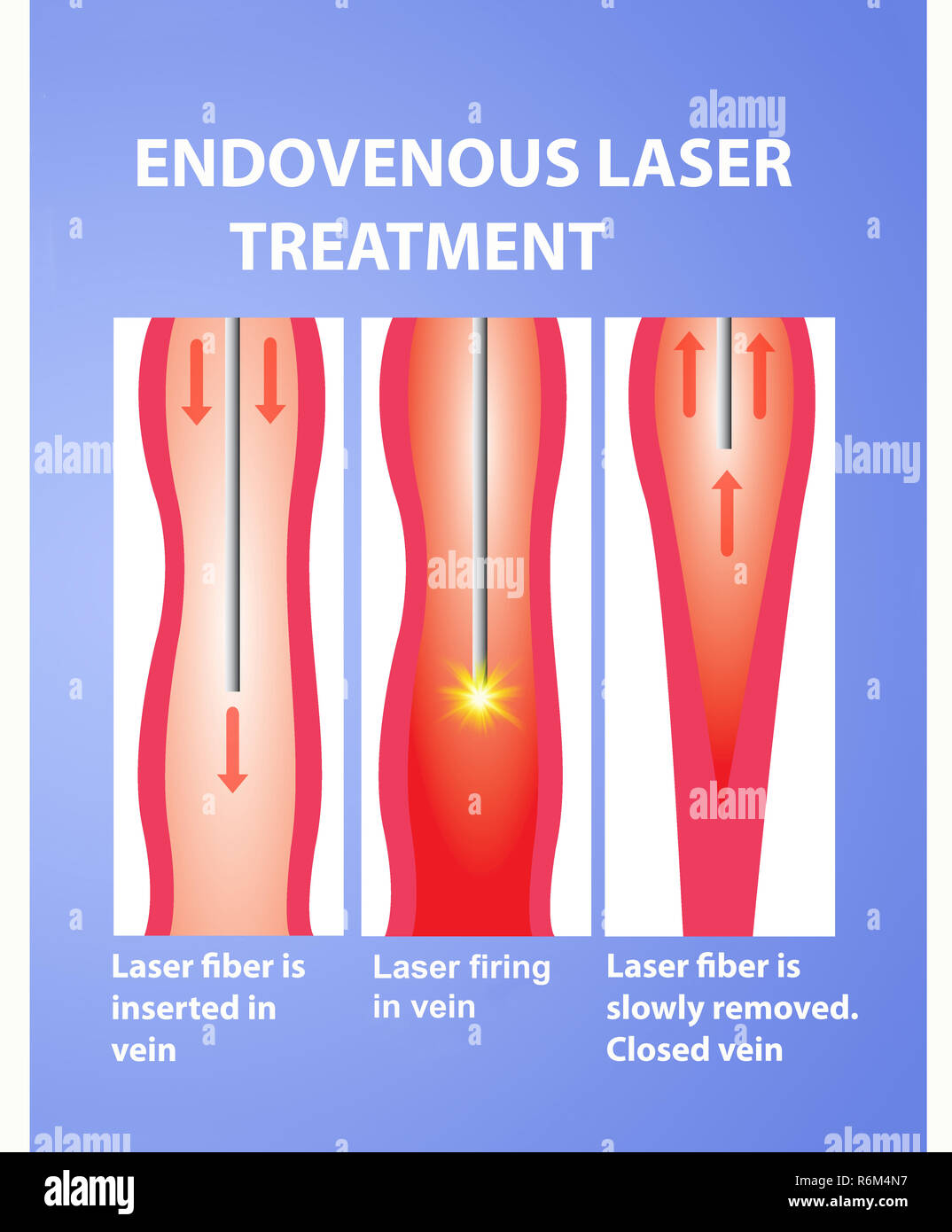 Varicose Veins and laser Stock Photo - Alamy