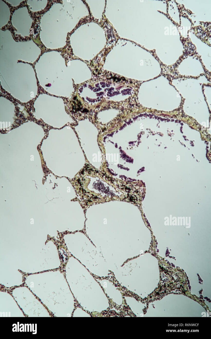 Lung tissue with asthma under the microscope hi-res stock photography ...