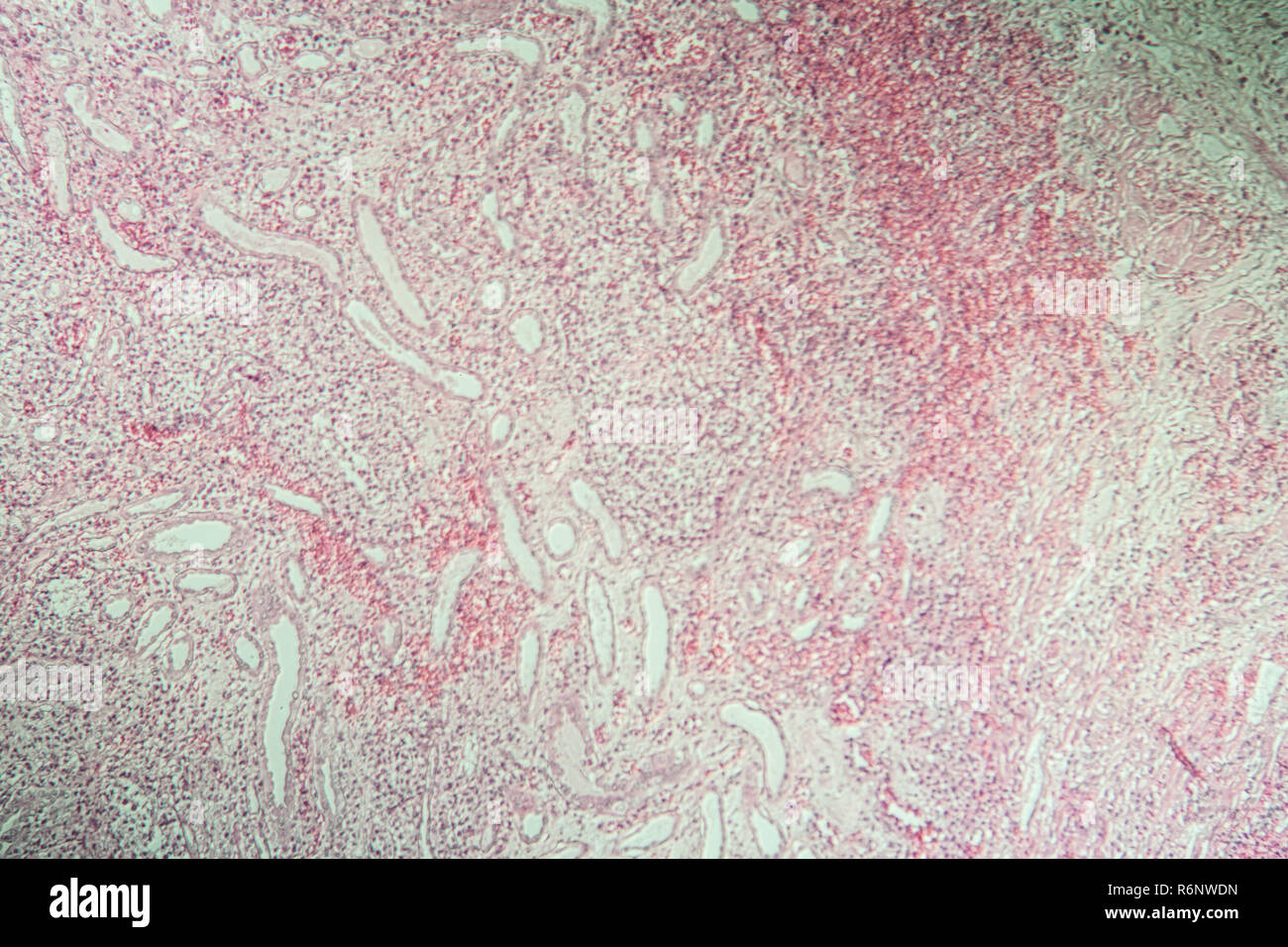 renal inflammation under the microscope Stock Photo - Alamy