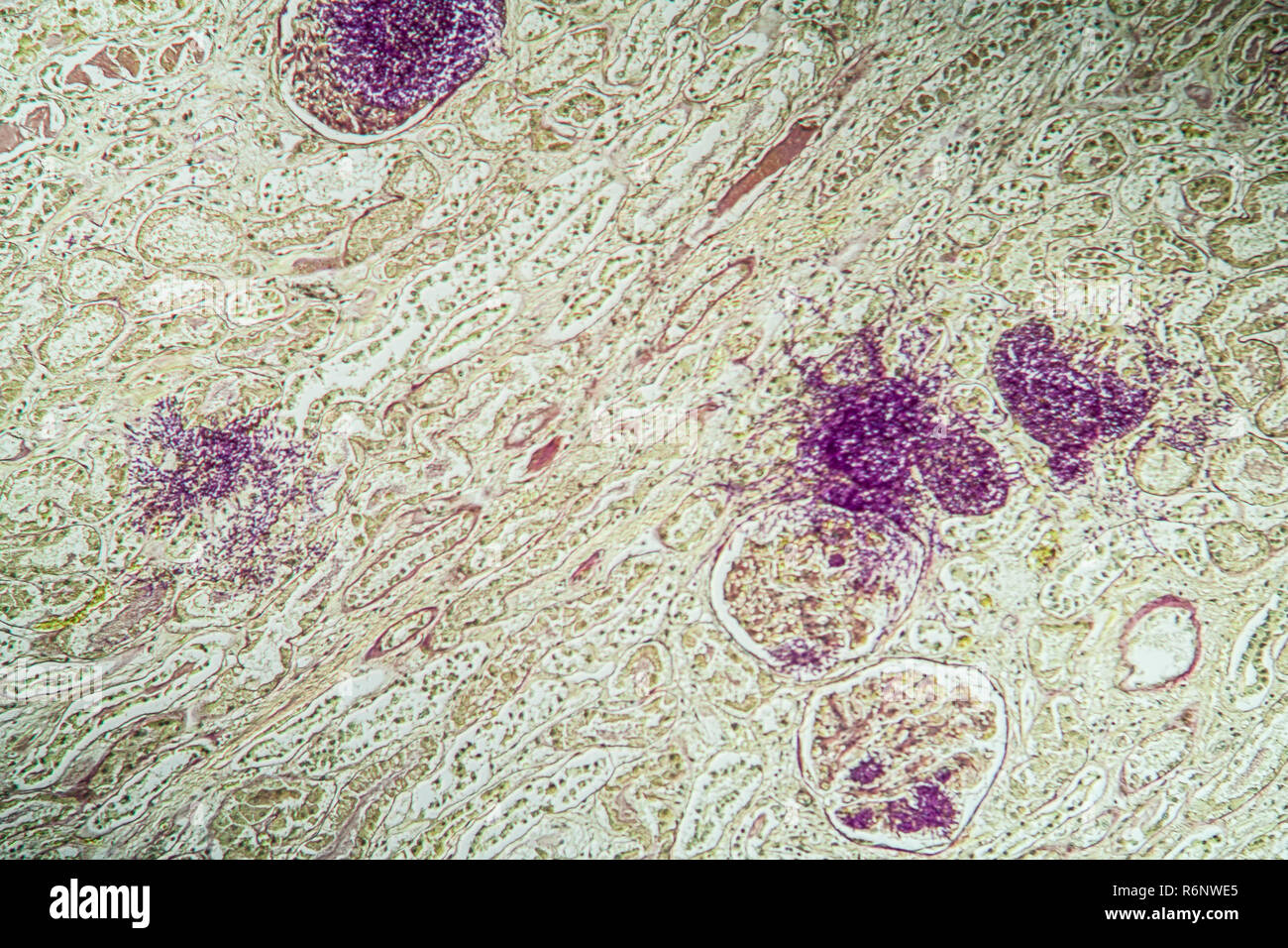 kidney of an aids patient under the microscope Stock Photo - Alamy