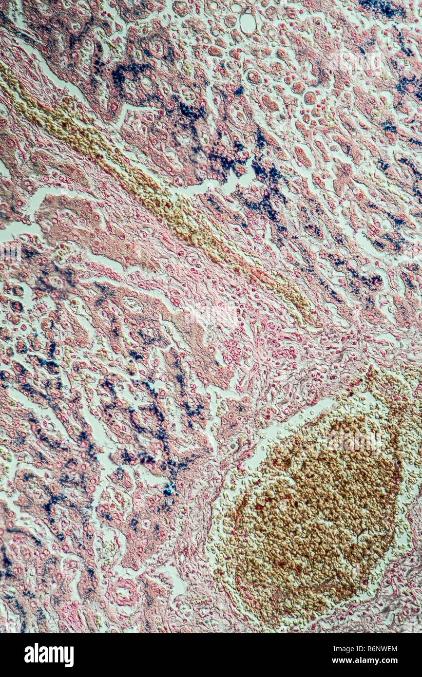 hemosiderosis under the microscope Stock Photo - Alamy
