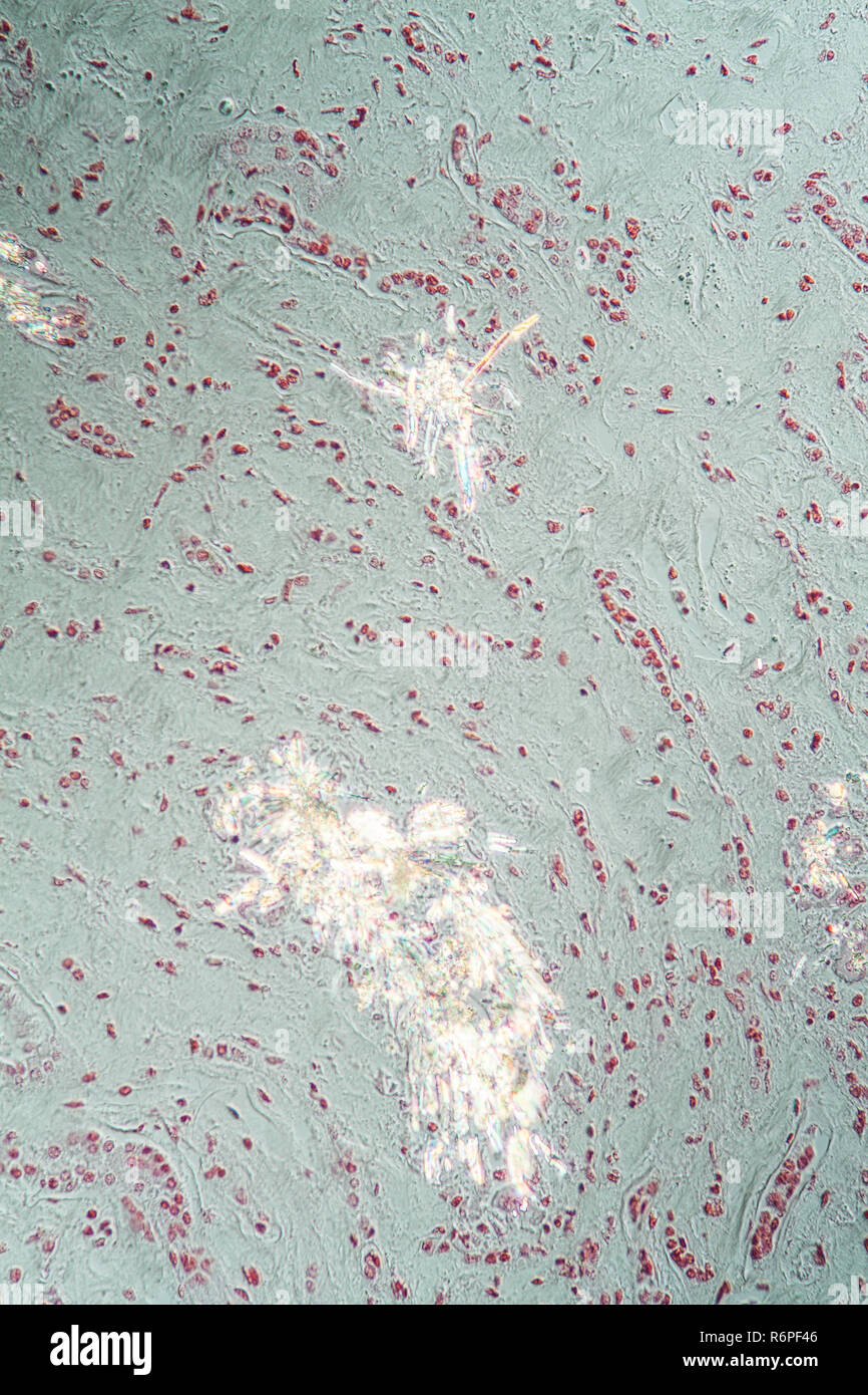 Gout crystals hi-res stock photography and images - Alamy