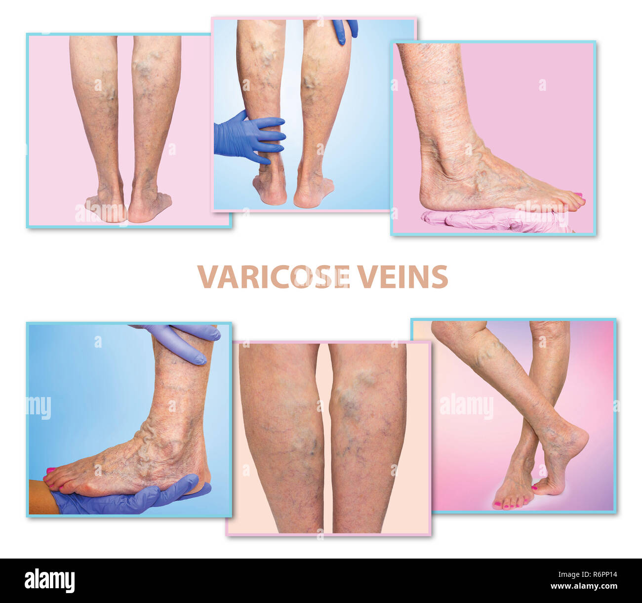 Painful varicose veins spider Cut Out Stock Images & Pictures - Alamy