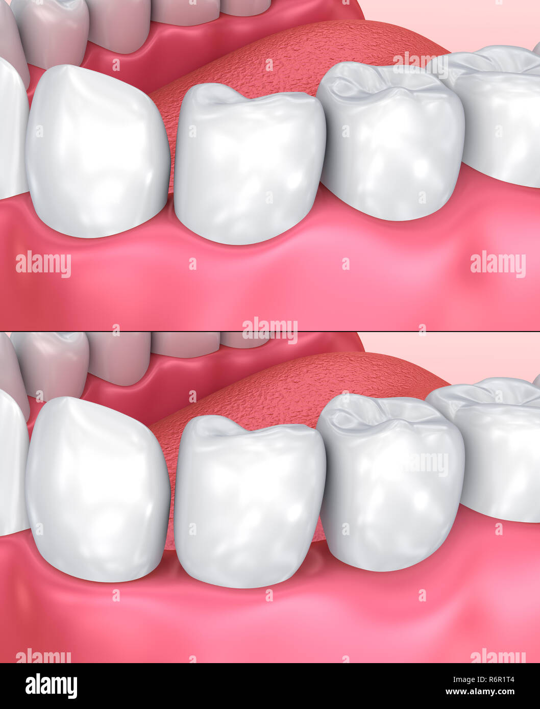 Normal and lowered gum. Medically accurate tooth 3D illustration Stock ...