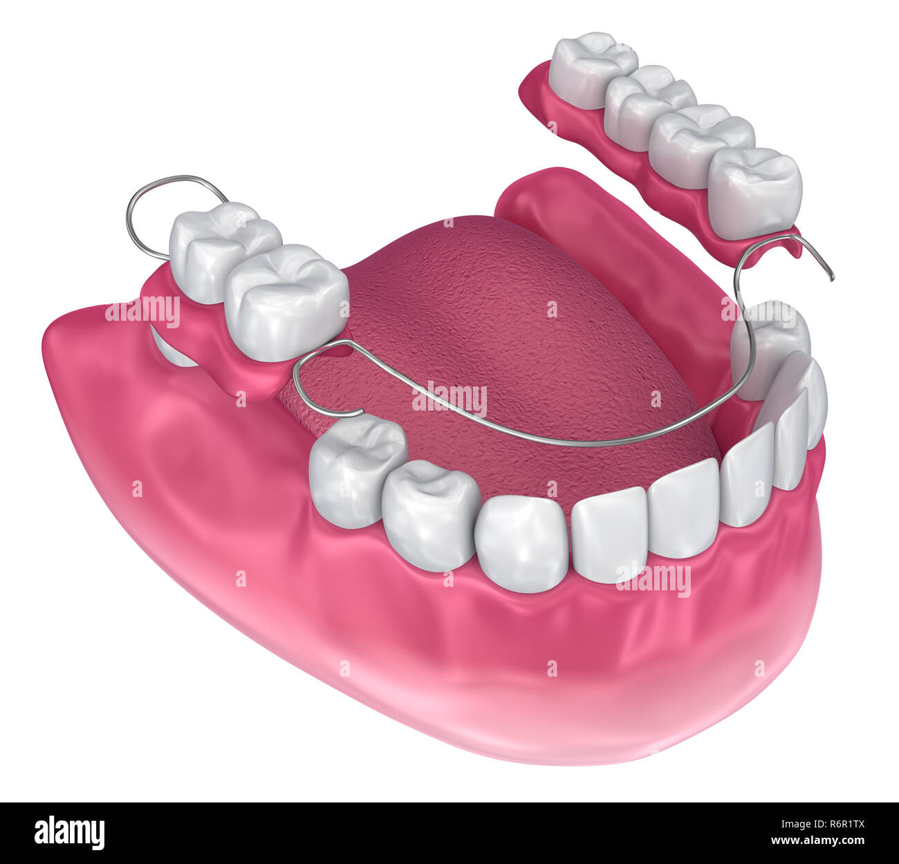 Removable partial denture. Medically accurate 3D illustration Stock ...