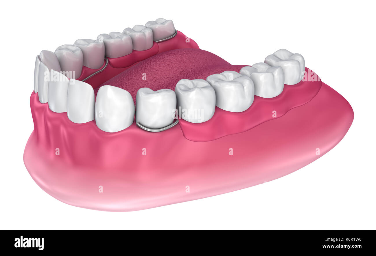 Removable partial denture. Medically accurate 3D illustration Stock ...