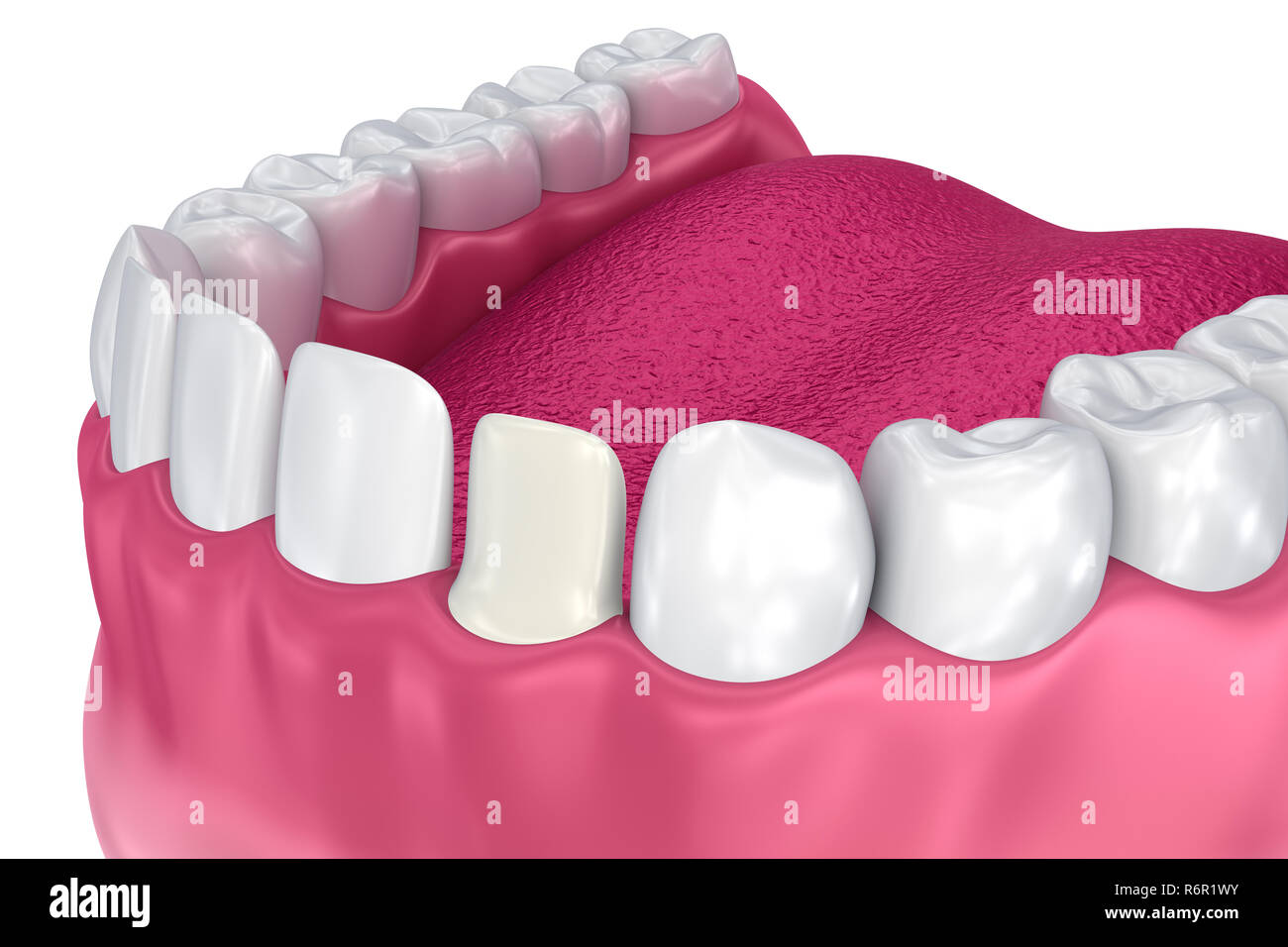 Teeth veneers install hi-res stock photography and images - Alamy