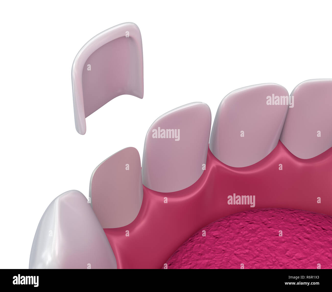 Teeth veneers install hi-res stock photography and images - Alamy