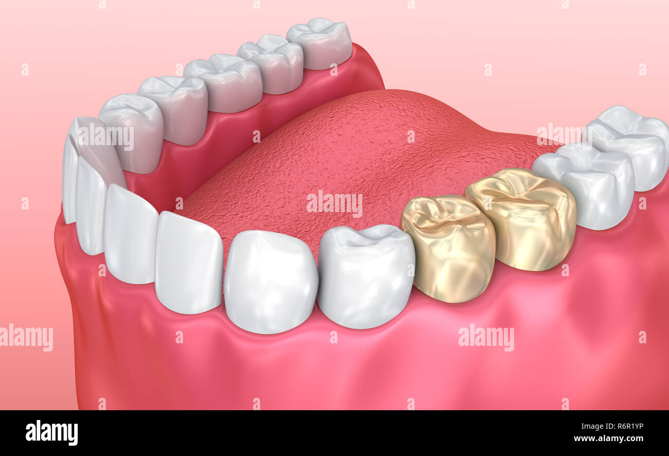 Healthy teeth and golden crowns, Medically accurate tooth 3D ...