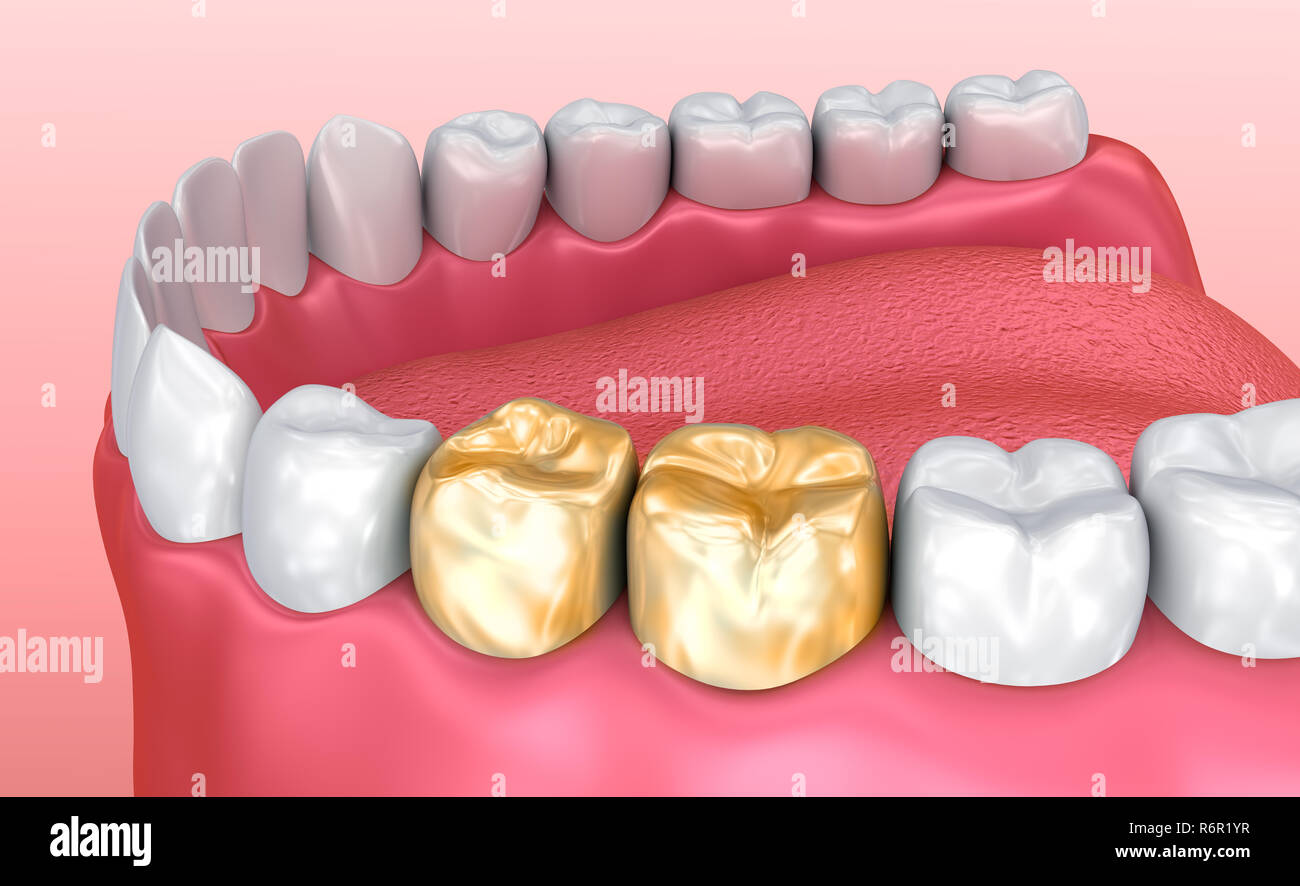 Healthy teeth and golden crowns, Medically accurate tooth 3D ...