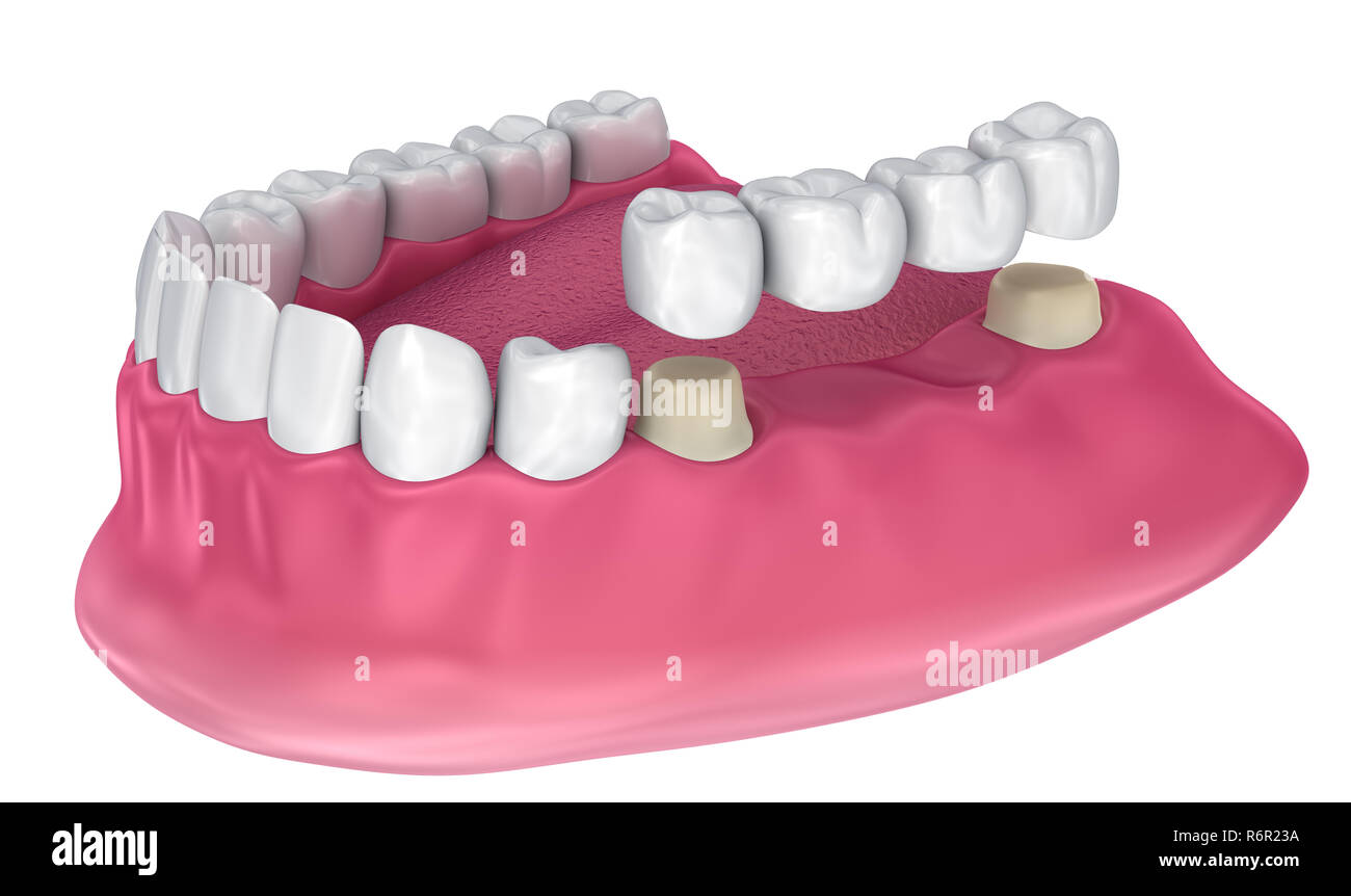 Tooth supported fixed bridge. Medically accurate 3D illustration Stock ...