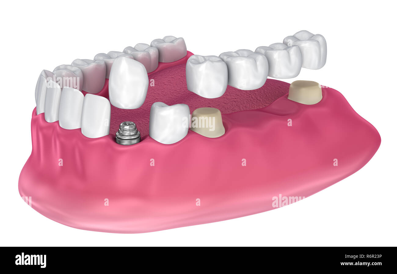 Tooth supported fixed bridge, implant and crown. Medically accurate 3D ...