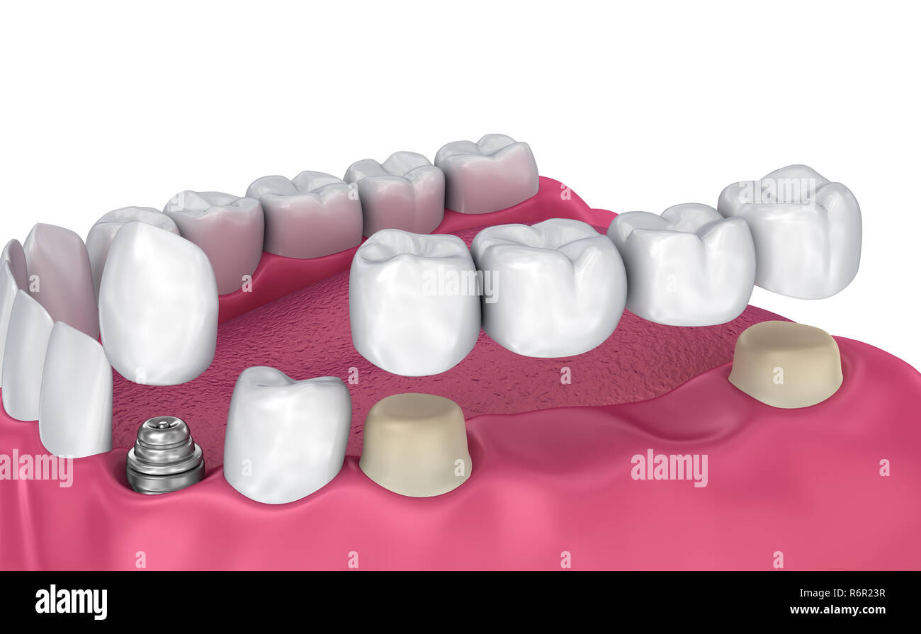 Tooth supported fixed bridge, implant and crown. Medically accurate 3D ...