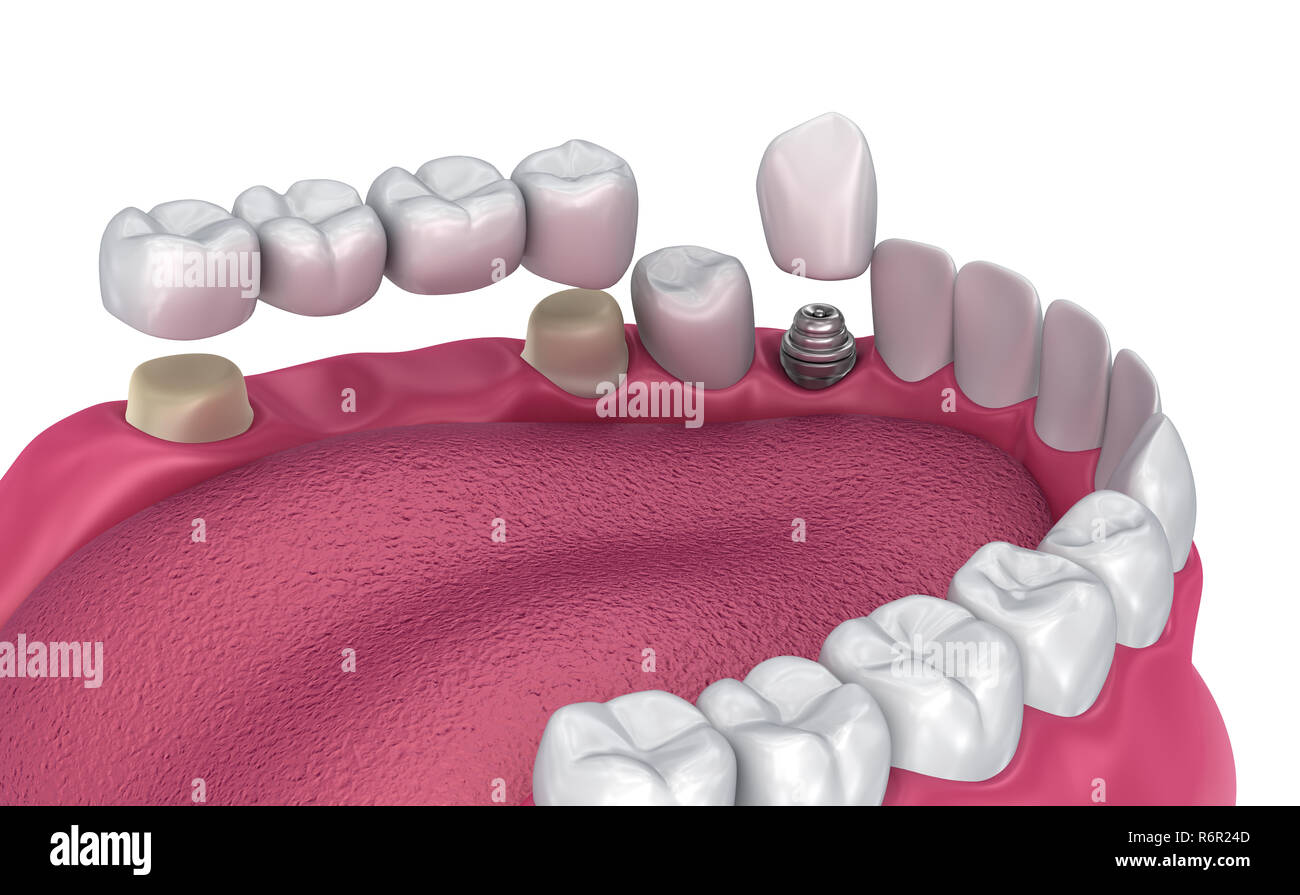 Tooth supported fixed bridge, implant and crown. Medically accurate 3D ...
